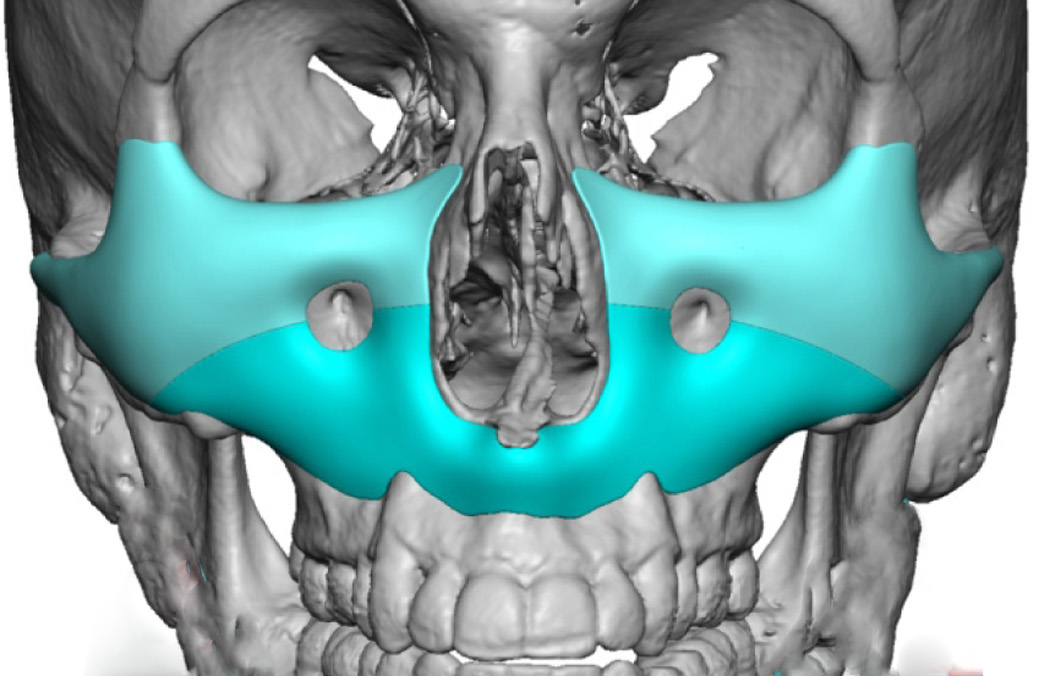The Different Types of Custom Mask Implants for Aesthetic Midface ...