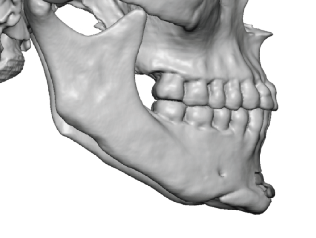Technical Strategies - The Westernized Approach to V-Line Jaw Reduction ...