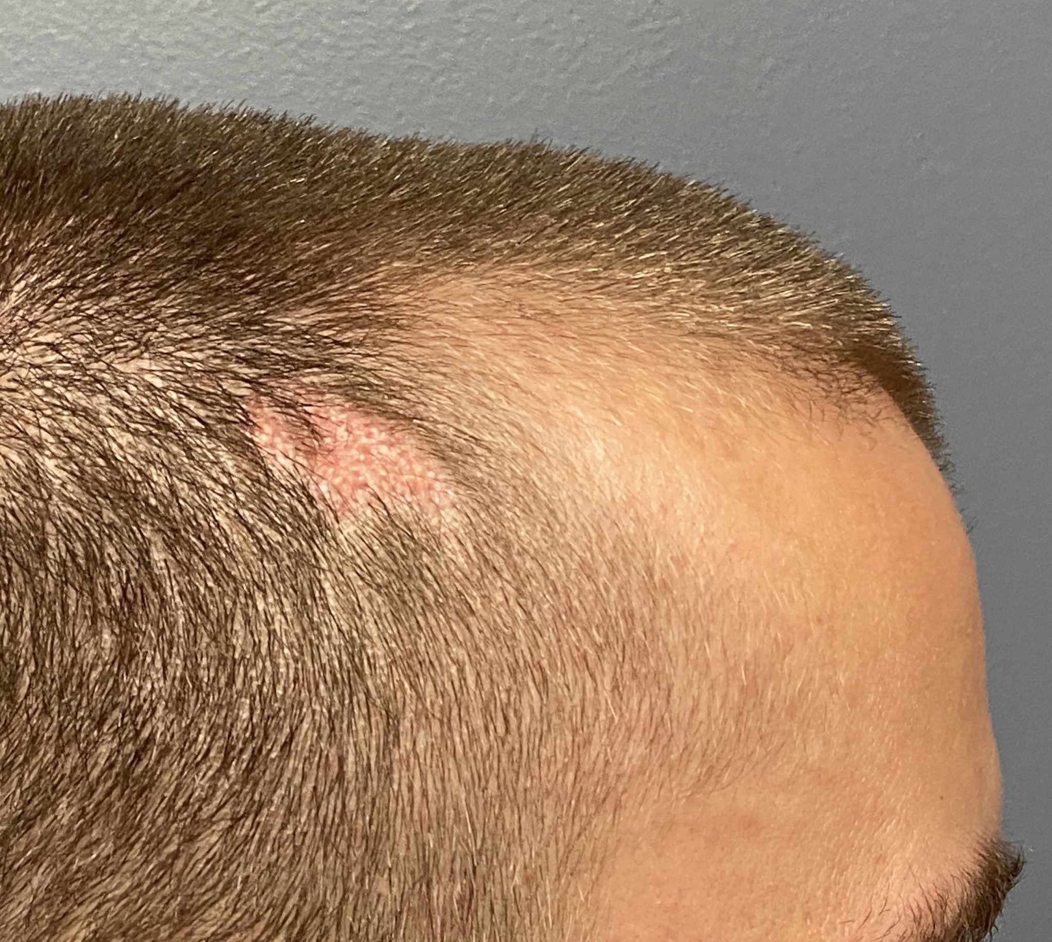 Plastic Surgery Case Study - Aesthetic Reduction of the Metopic Midline ...