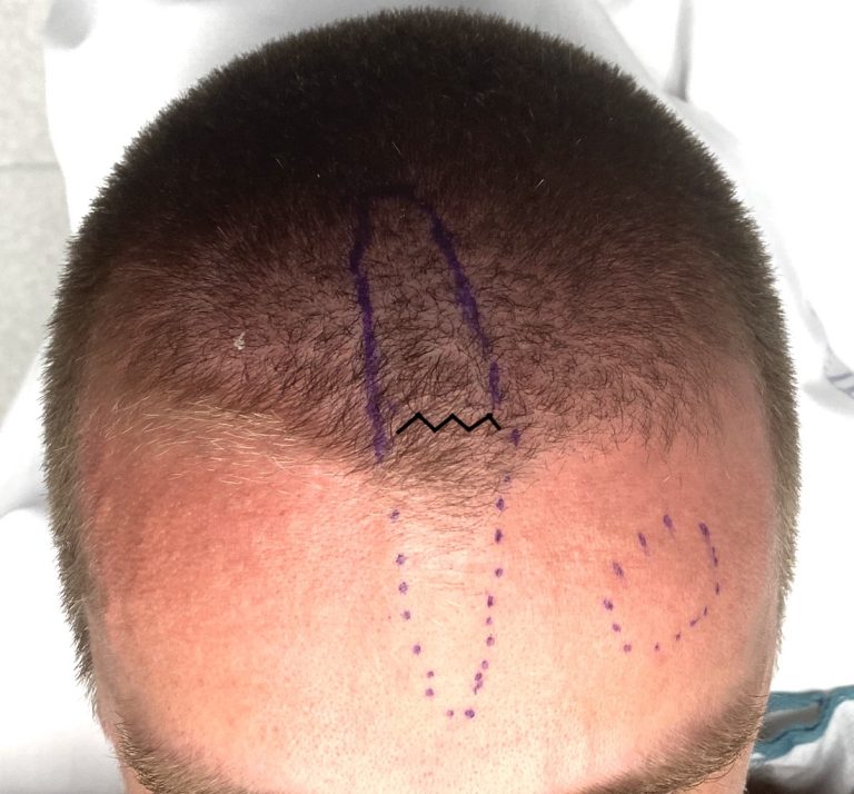 anterior sagittal and metopic ridge reduction markings Dr Barry Eppley ...