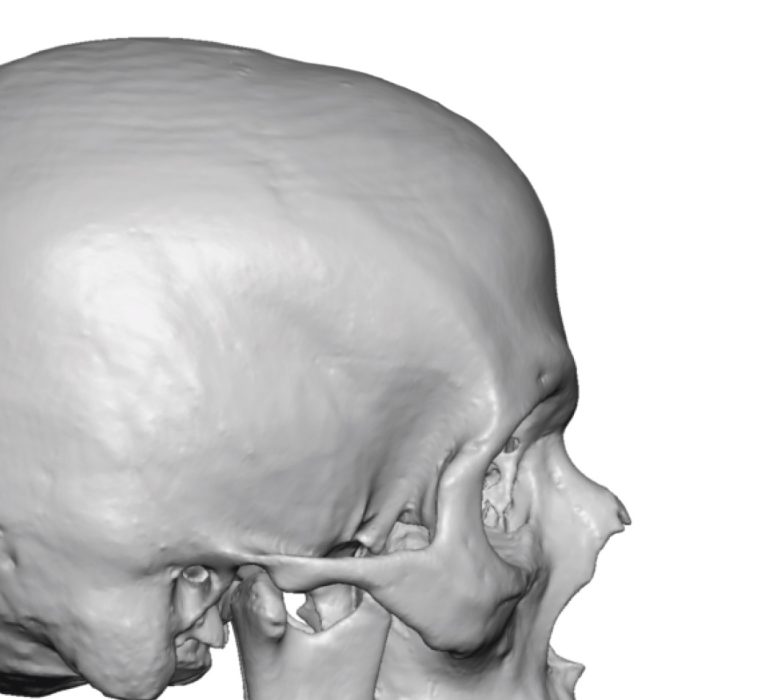 anterior sagittal crest and mnetopic ridge 3D CT scan side view ...