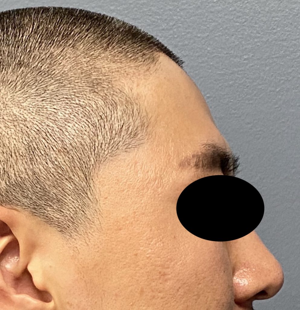 asian male forehead-brow bone implant side 1 Dr Barry Eppley copy ...