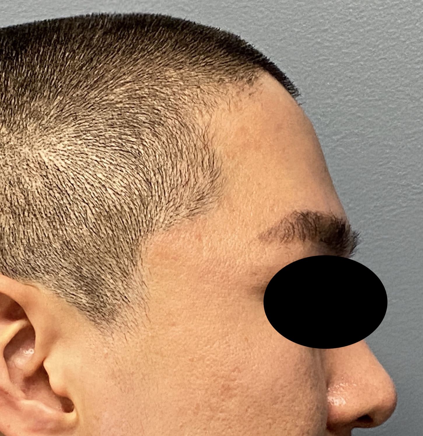 asian male forehead brow bone implant side 2 Dr Barry Eppley copy ...