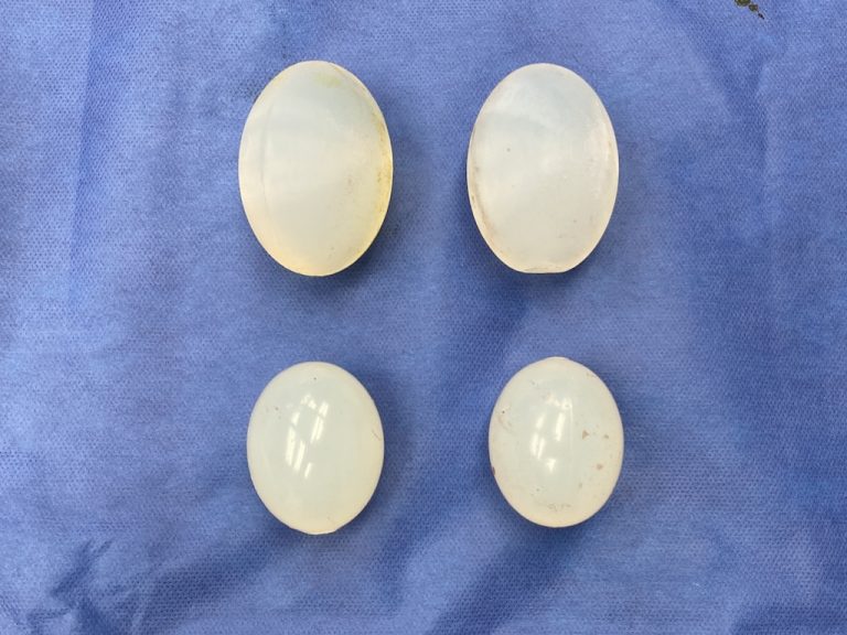 Plastic Surgery Case Study - Solving the Four Pack Testicle Enhancement ...