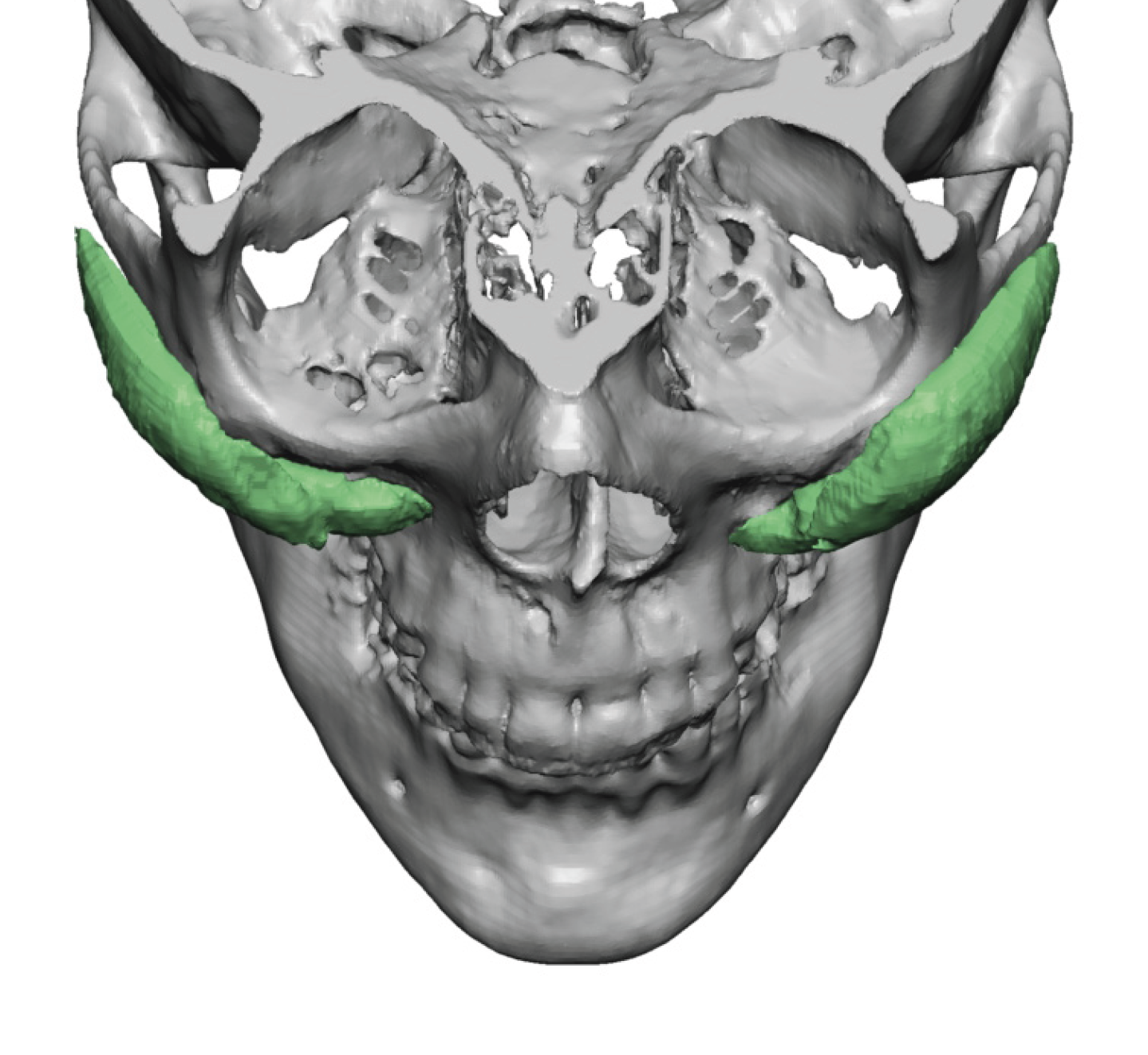 douboe stacked aubmalar cheek implants 3D Ct scan top view Dr Barry ...