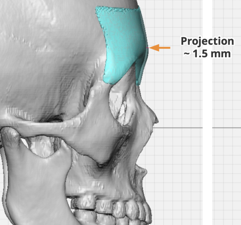 Plastic Surgery Case Study - Female Custom Brow Bone Implant ...