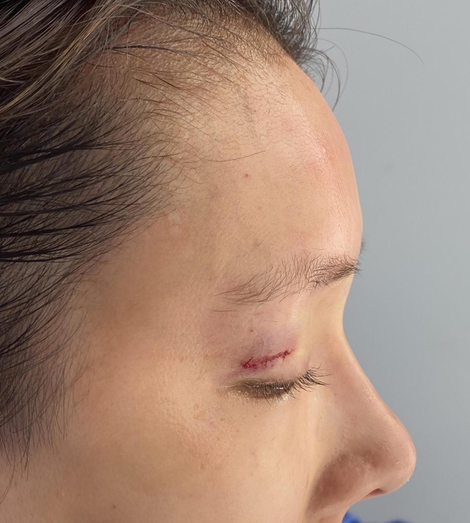 Plastic Surgery Case Study - Female Custom Brow Bone Implant ...