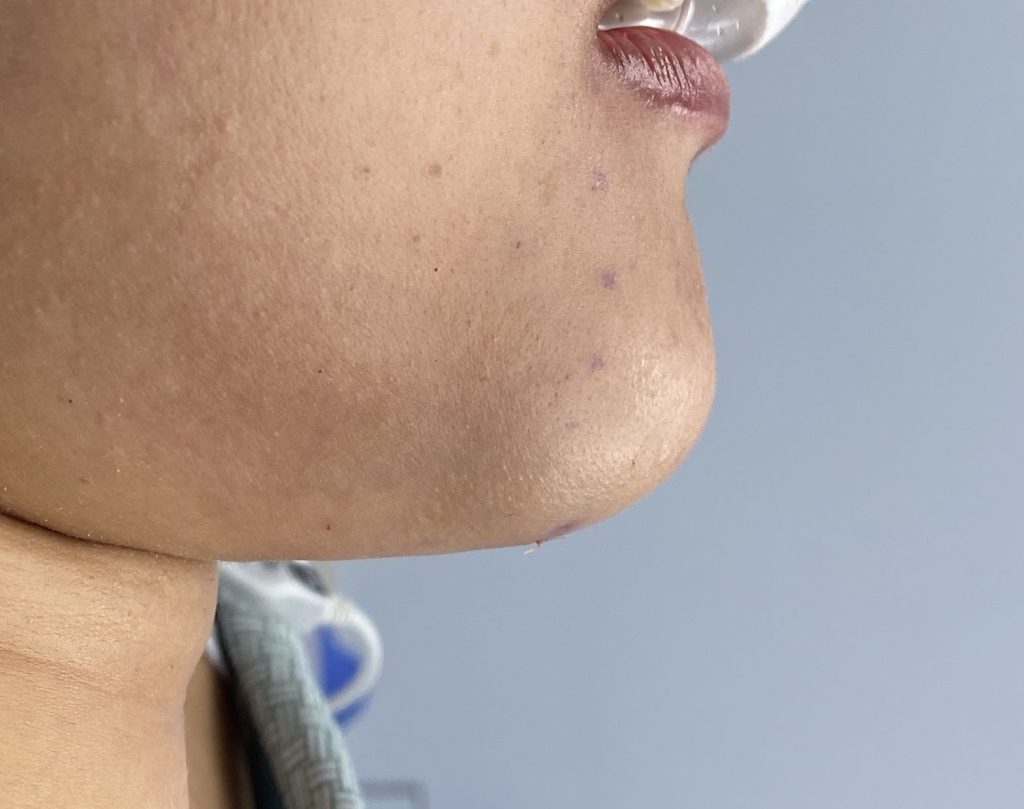 Plastic Surgery Case Study - Female Chin Reduction by Saw Cut Bone ...