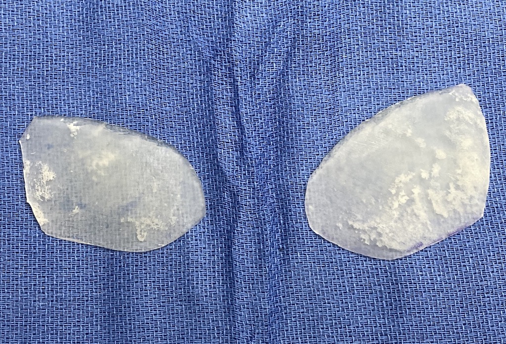 female lateral facial implants Dr Barry Eppley - Explore Plastic Surgery