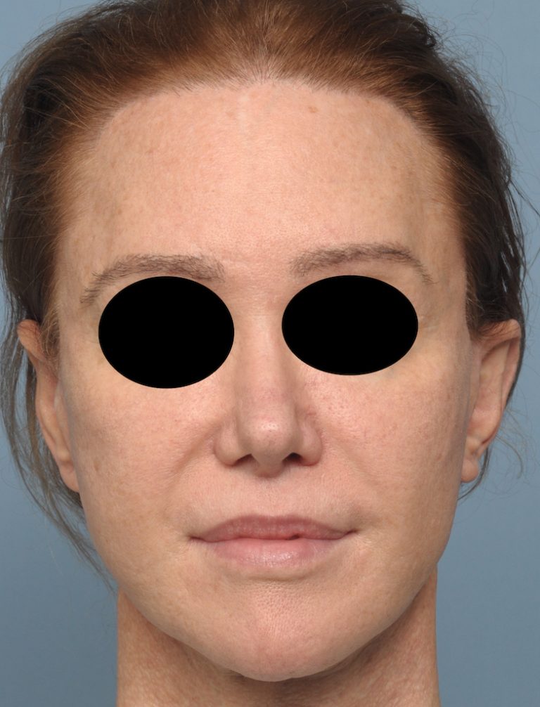 Plastic Surgery Case Study - Temporal and Lateral Facial Implants for ...