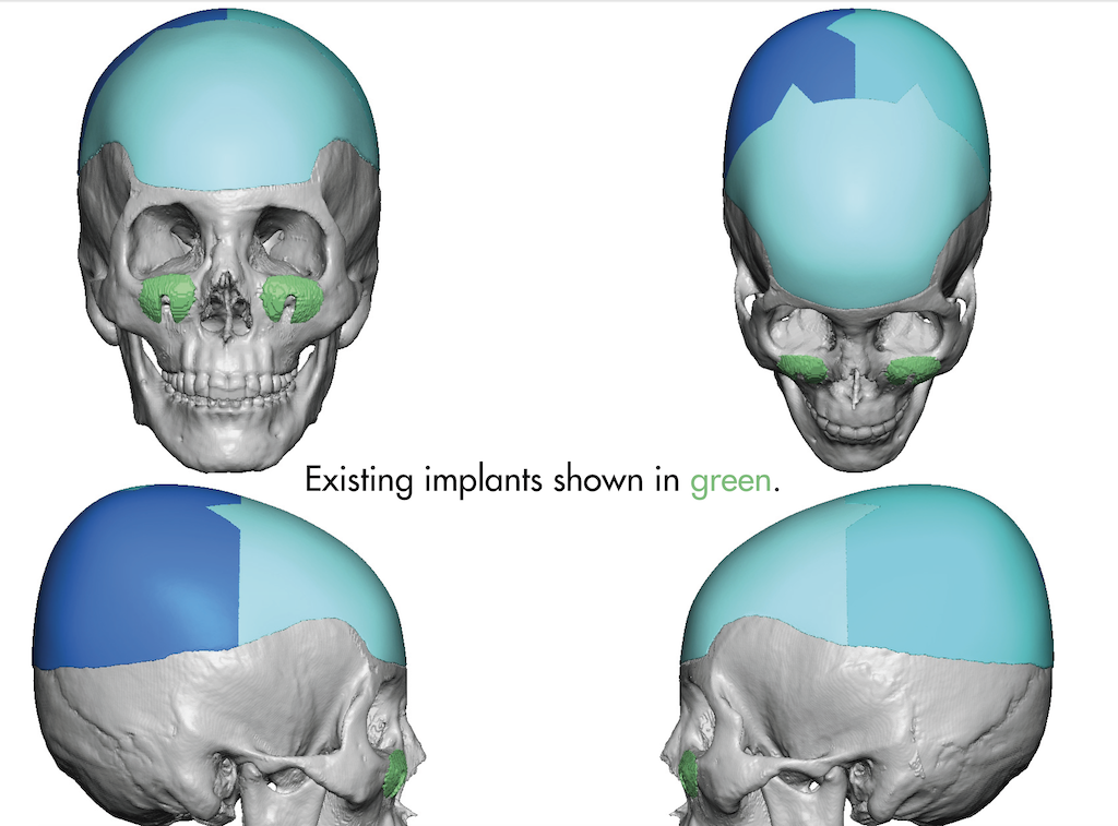 Plastic Surgery Case Study - 1st Stage Scalp Expander Placement in ...