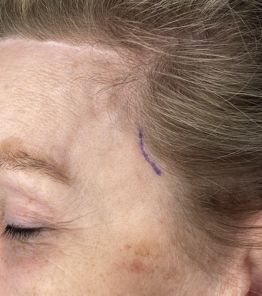 Technical Strategies - Incisional Access for Temporal Implant ...