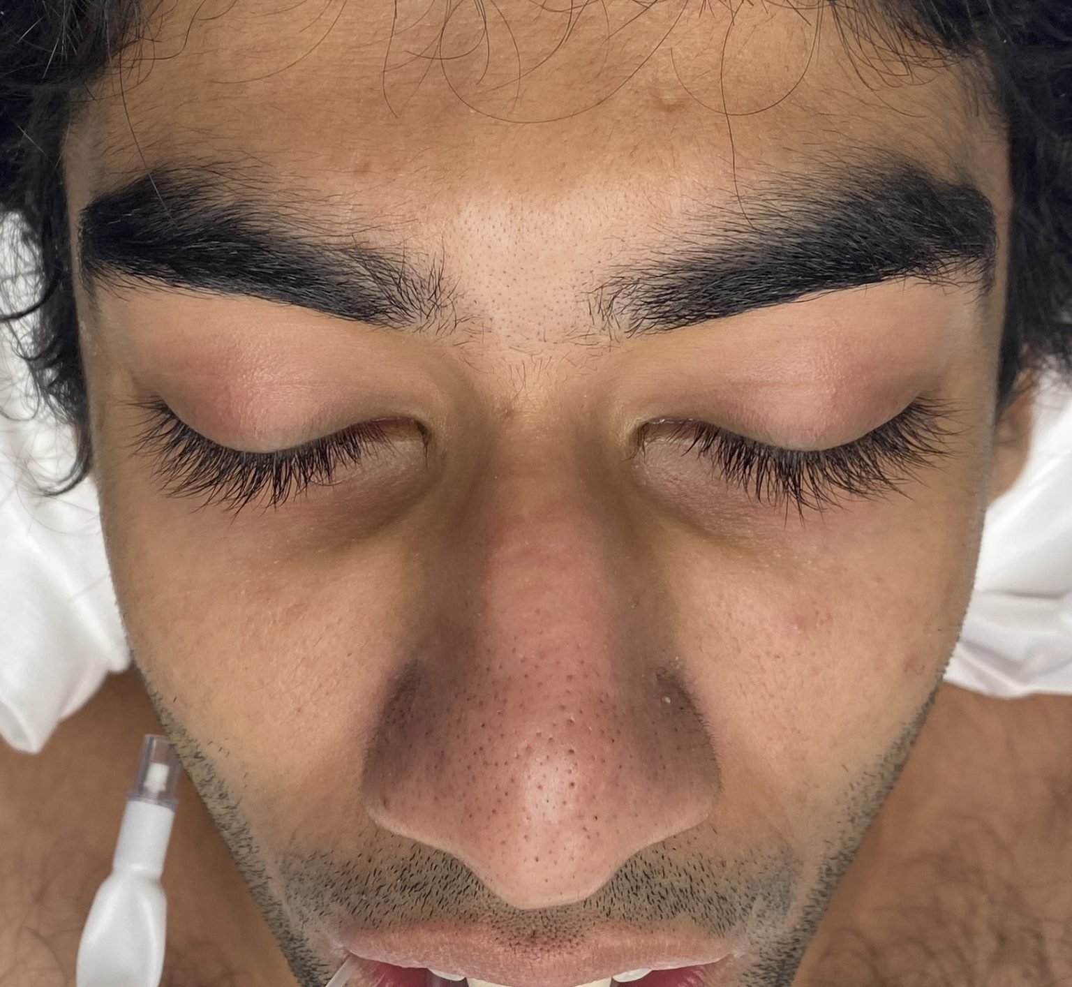 Plastic Surgery Case Study - Widening the Narrow Face with Zygomatic ...