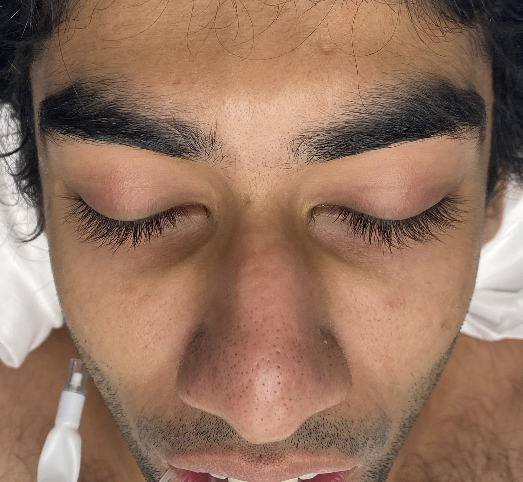 male cheek widening osteotomy frnt 1 intraop Dr Barry Eppley - Explore ...