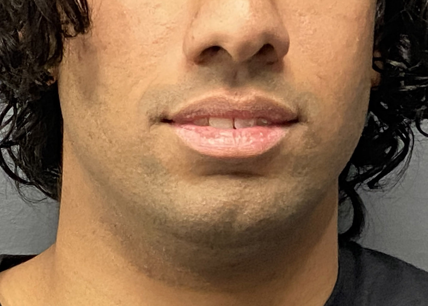 Plastic Surgery Case Study - Male Vertical Chin Lengthening with a ...