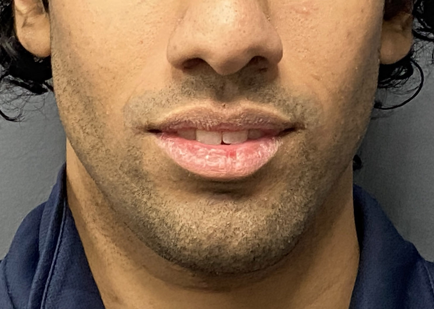 Plastic Surgery Case Study - Male Vertical Chin Lengthening with a ...