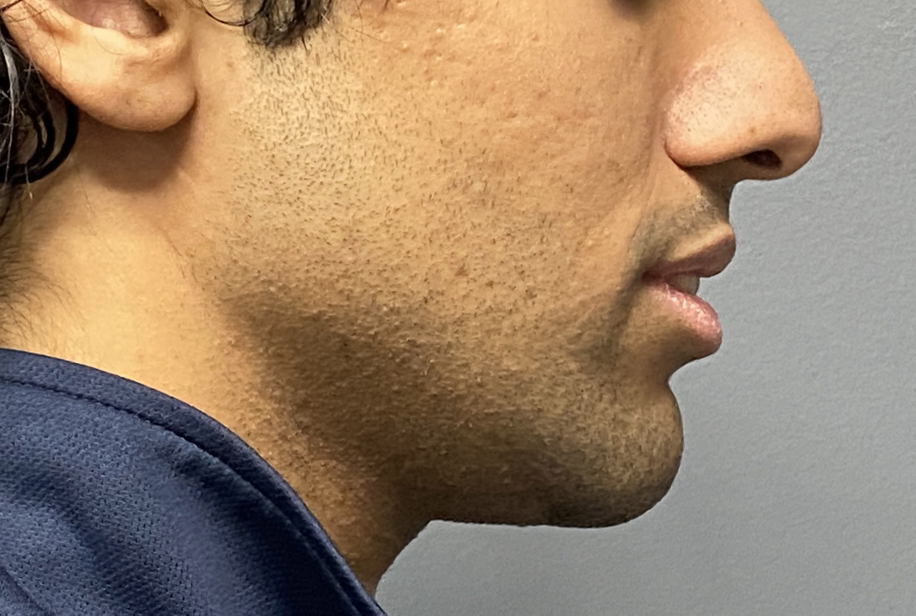 Plastic Surgery Case Study - Male Vertical Chin Lengthening with a ...