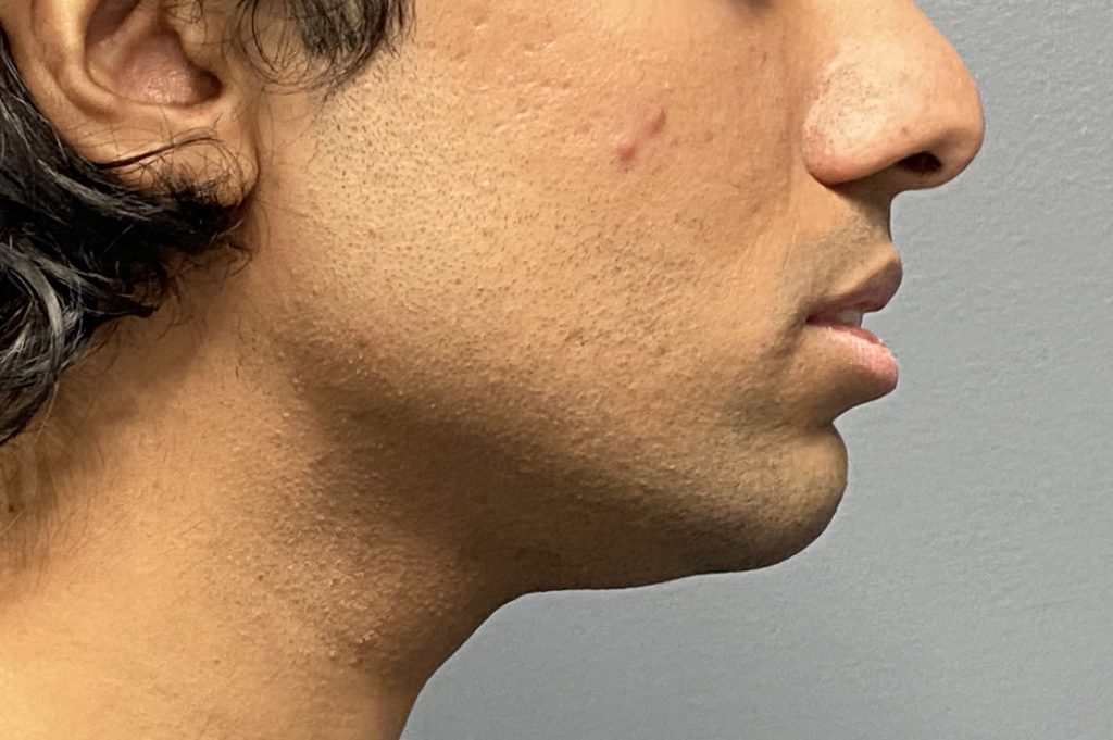 Plastic Surgery Case Study - Male Vertical Chin Lengthening with a ...