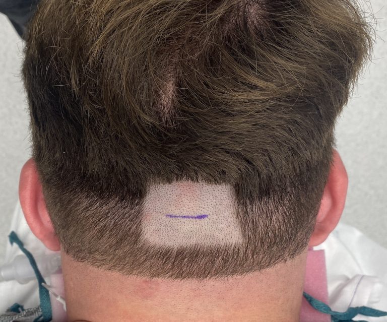 Technical Strategies - The Small Incisional Approach to Occipital Knob ...