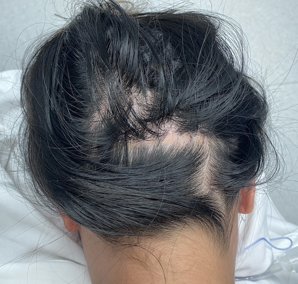 Plastic Surgery Case Study - 1st Stage Scalp Expander Placement in ...