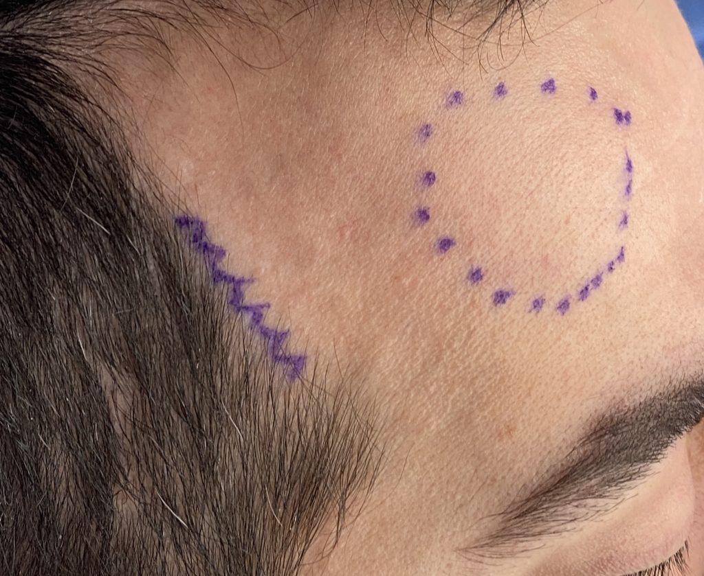 Plastic Surgery Case Study - Temporal Hairline Incisions for Bony ...