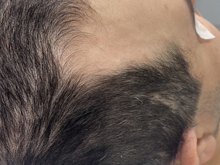 right temporal hairline scar Dr Barry Eppley - Explore Plastic Surgery