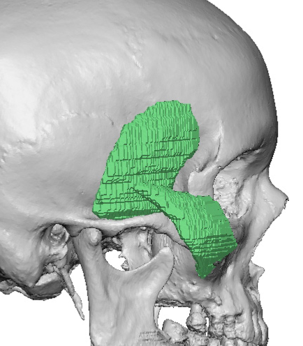 Technical Strategies - Incisional Access for Temporal Implant ...