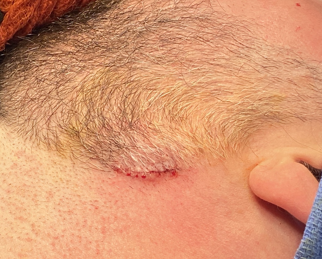 Technical Strategies - The Transcutaneous Approach to Jaw Angle Implant ...