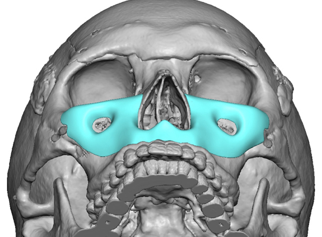 The Different Types of Custom Mask Implants for Aesthetic Midface ...