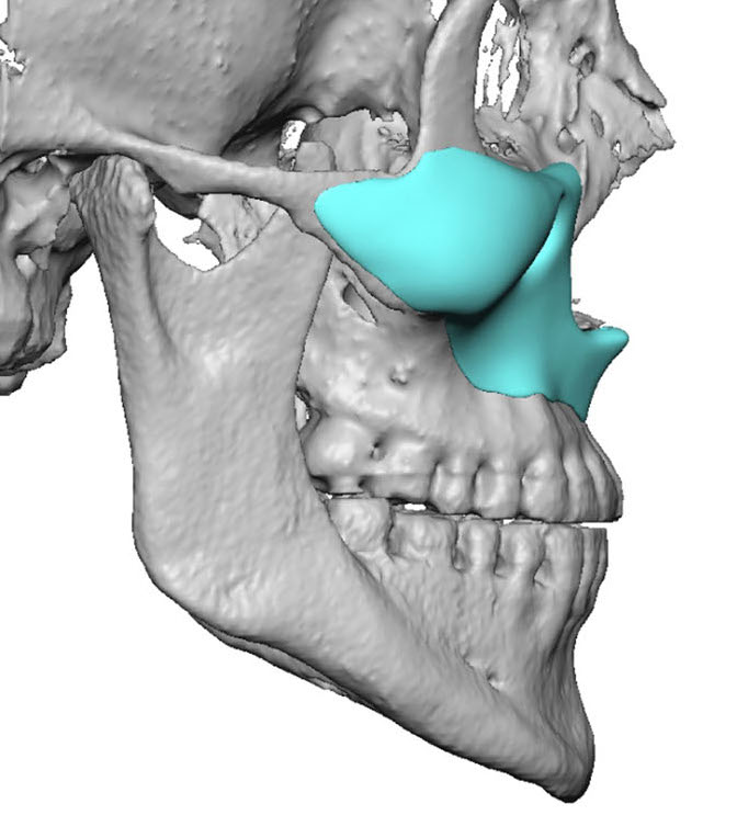 The Different Types of Custom Mask Implants for Aesthetic Midface Augmentations - Explore ...
