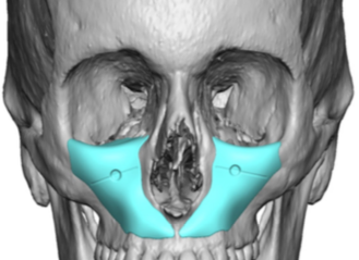The Different Types of Custom Mask Implants for Aesthetic Midface ...