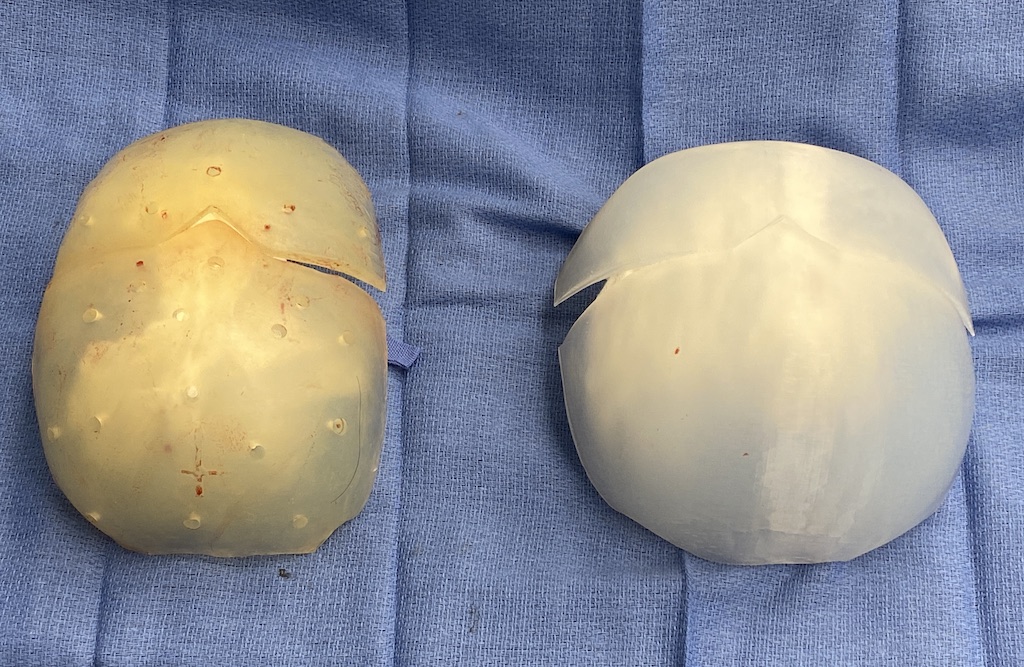 2nd vs 1st custom forehead-skull implant comparison Dr Barry Eppley ...