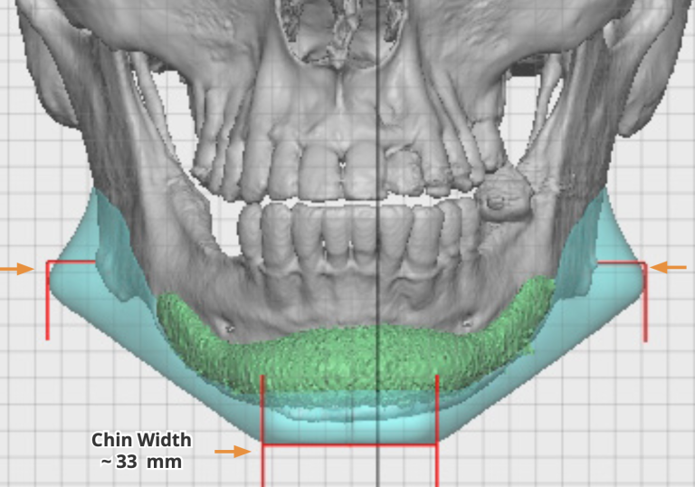 Plastic Surgery Case Study - Custom Jawline Implant Replacement of ...