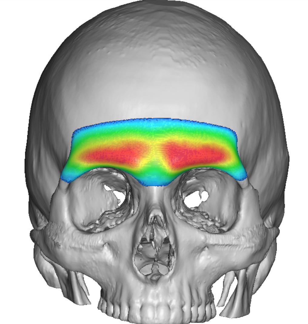 Plastic Surgery Case Study - Male Custom Brow Bone Implant Augmentation ...