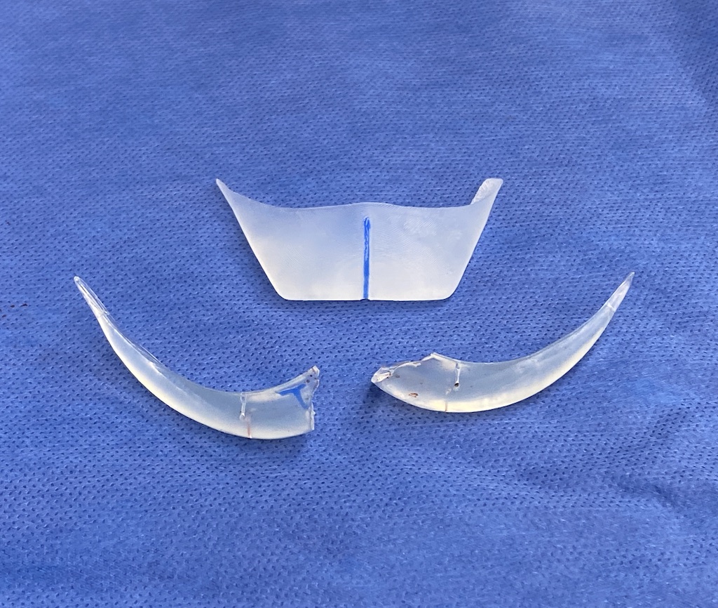 Plastic Surgery Case Study - Non-Linear Custom Jawline Implants with a ...