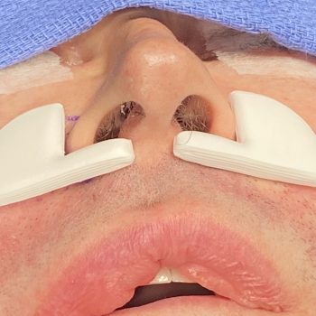 facial implants Archives - Explore Plastic Surgery