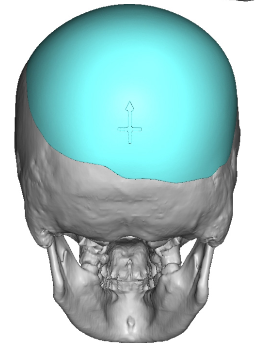 female custom back of head skull implant design Dr Barry Eppley ...