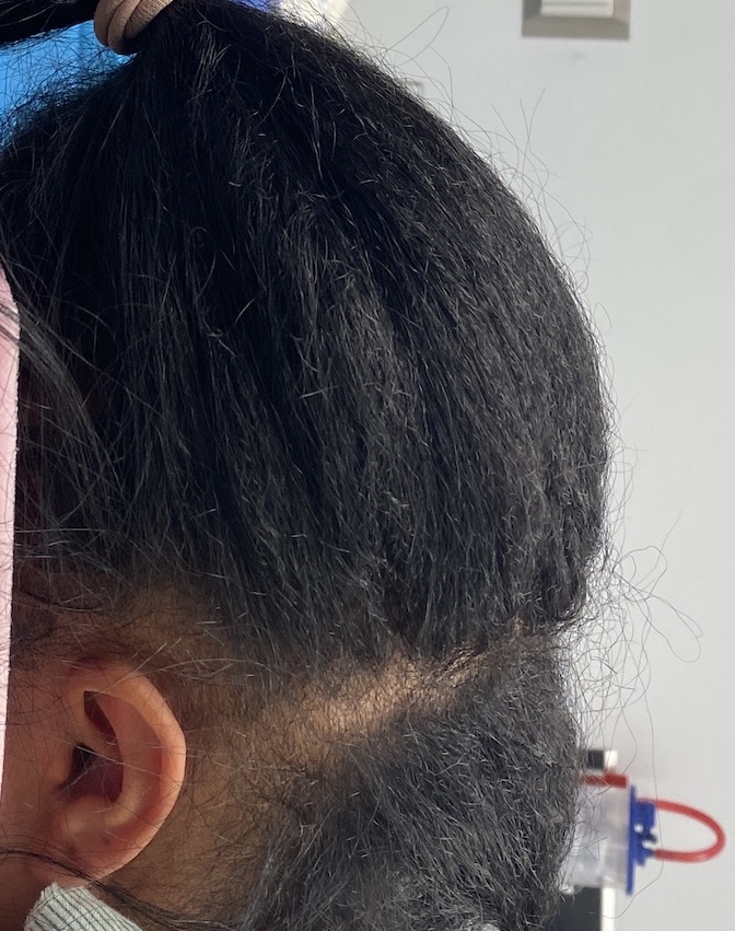 Plastic Surgery Case Study - Custom Skull Implant for Female Flat Back ...