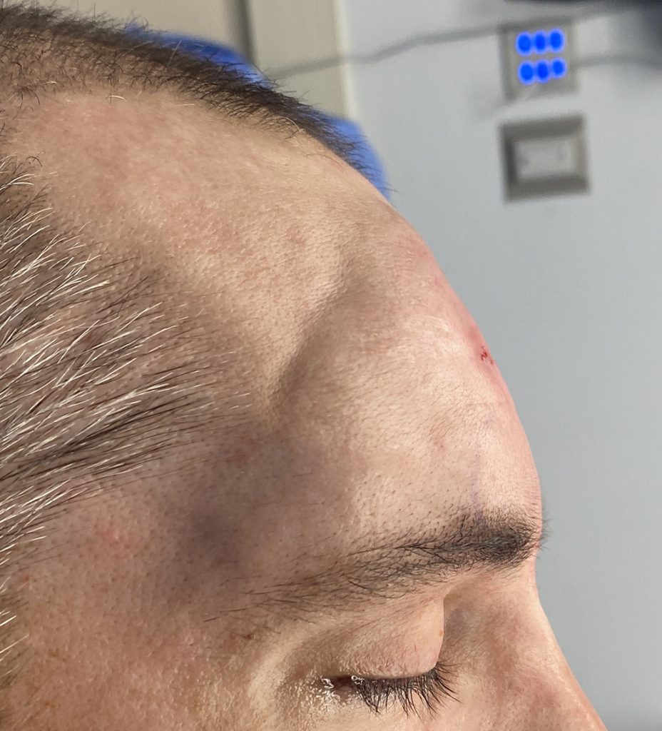 Plastic Surgery Case Study - The Male Mid-Forehead Approach to Brow ...