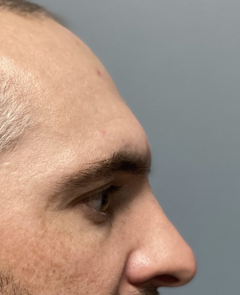 Plastic Surgery Case Study - The Male Mid-Forehead Approach to Brow ...