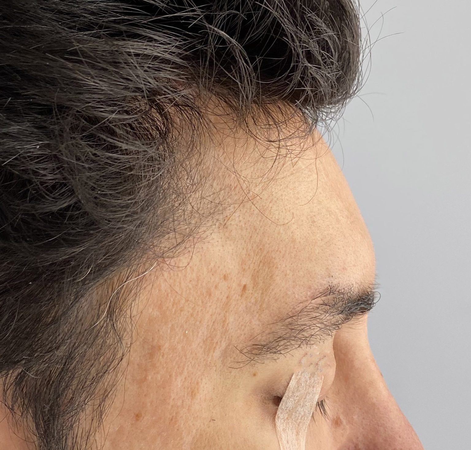 male custom forehead implant side 1 Dr Barry Eppley - Explore Plastic ...