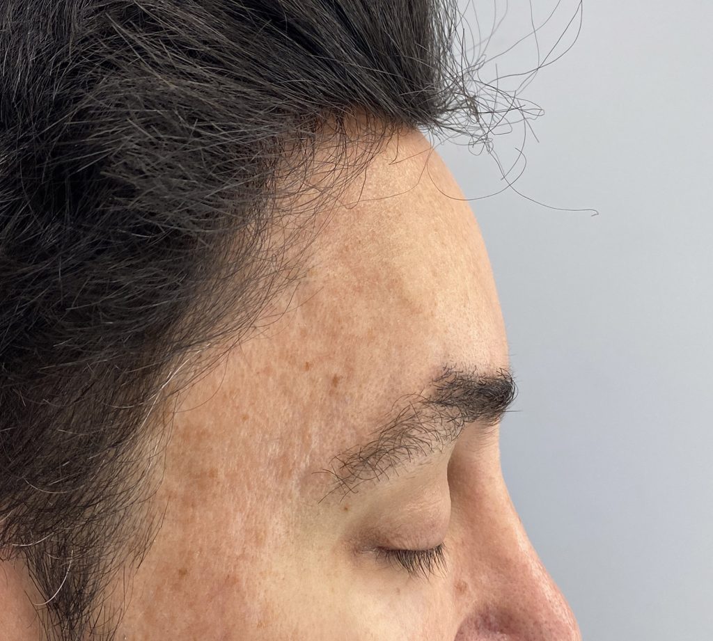 Plastic Surgery Case Study - The Male Extended Custom Forehead-Skull ...