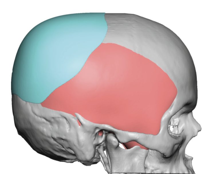 Plastic Surgery Case Study - Correction of the Forward Sloping Skull ...