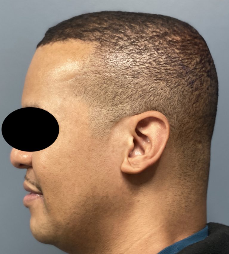 Plastic Surgery Case Study - Correction of the Forward Sloping Skull ...