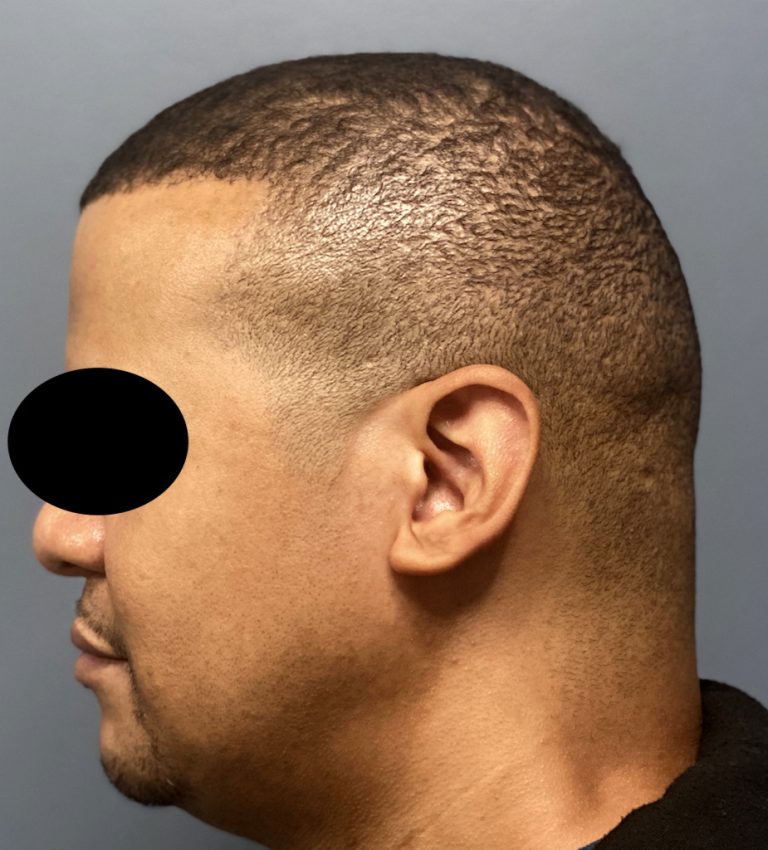 Plastic Surgery Case Study - Correction of the Forward Sloping Skull ...