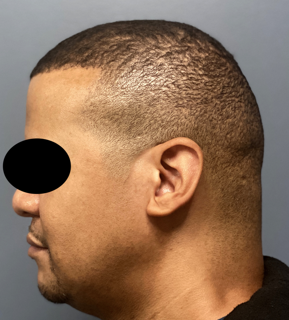 Plastic Surgery Case Study - Correction of the Forward Sloping Skull ...