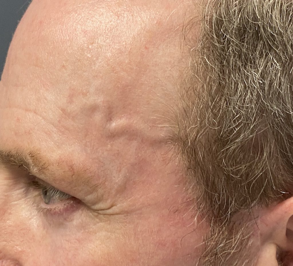 Plastic Surgery Case Study - Surgical Treatment of the Type 1 Prominent ...