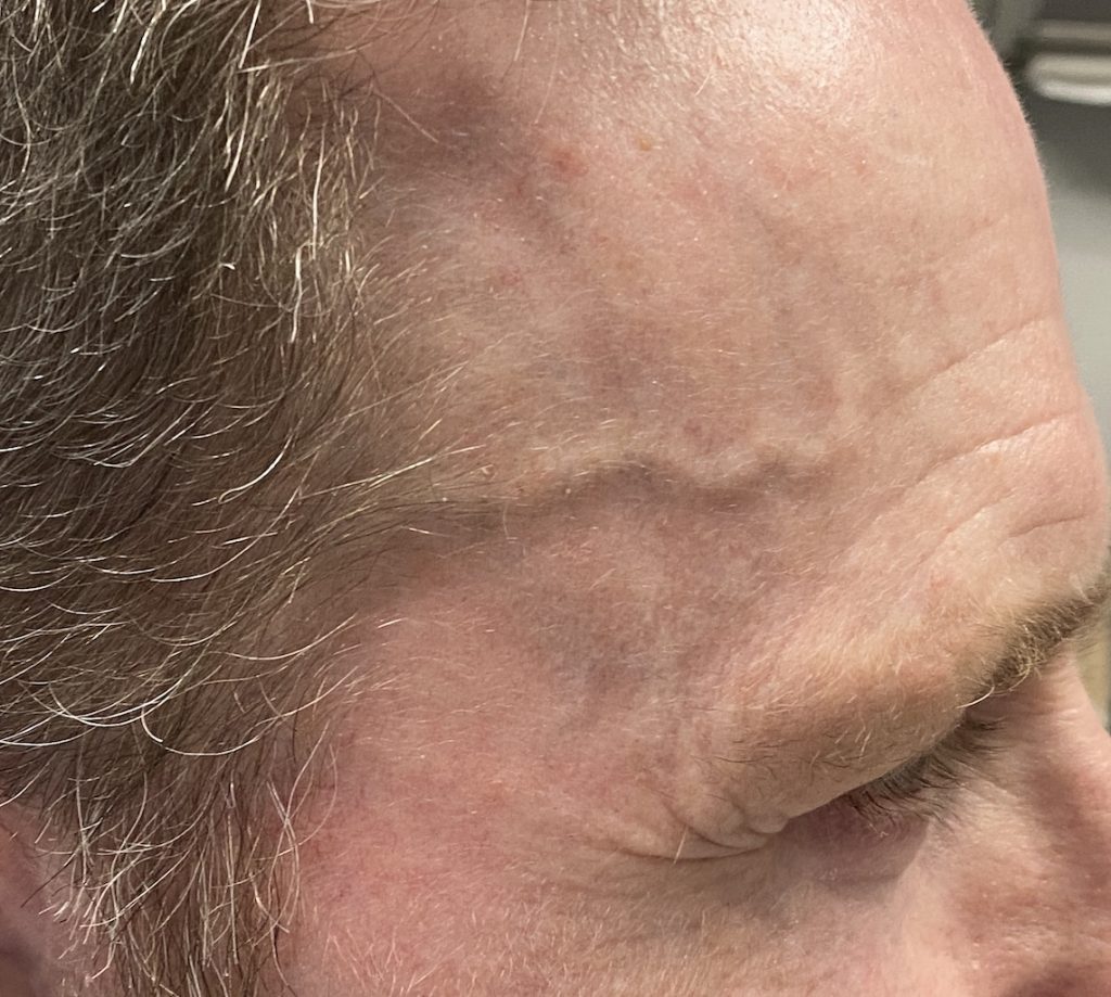 Plastic Surgery Case Study - Surgical Treatment of the Type 1 Prominent ...