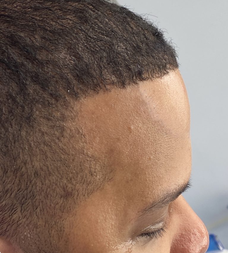 Plastic Surgery Case Study - Correction of the Forward Sloping Skull ...