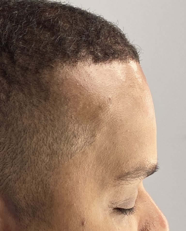 male forehead bossing reduction side 2 Dr Barry Eppley - Explore ...